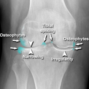 Understanding X-Rays of Arthritic Knees: What They Reveal