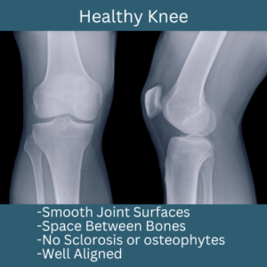 Understanding X-Rays of Arthritic Knees: What They Reveal