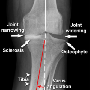 Understanding X-Rays of Arthritic Knees: What They Reveal
