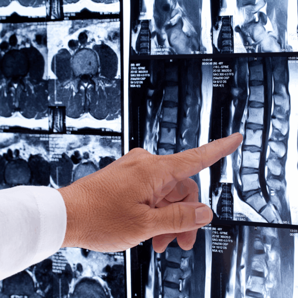 Degenerative Disc Disease MRI: What It Means & How to Treat