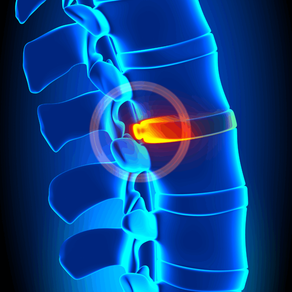 Disc Bulges on MRI: When to Worry (and When Not To)